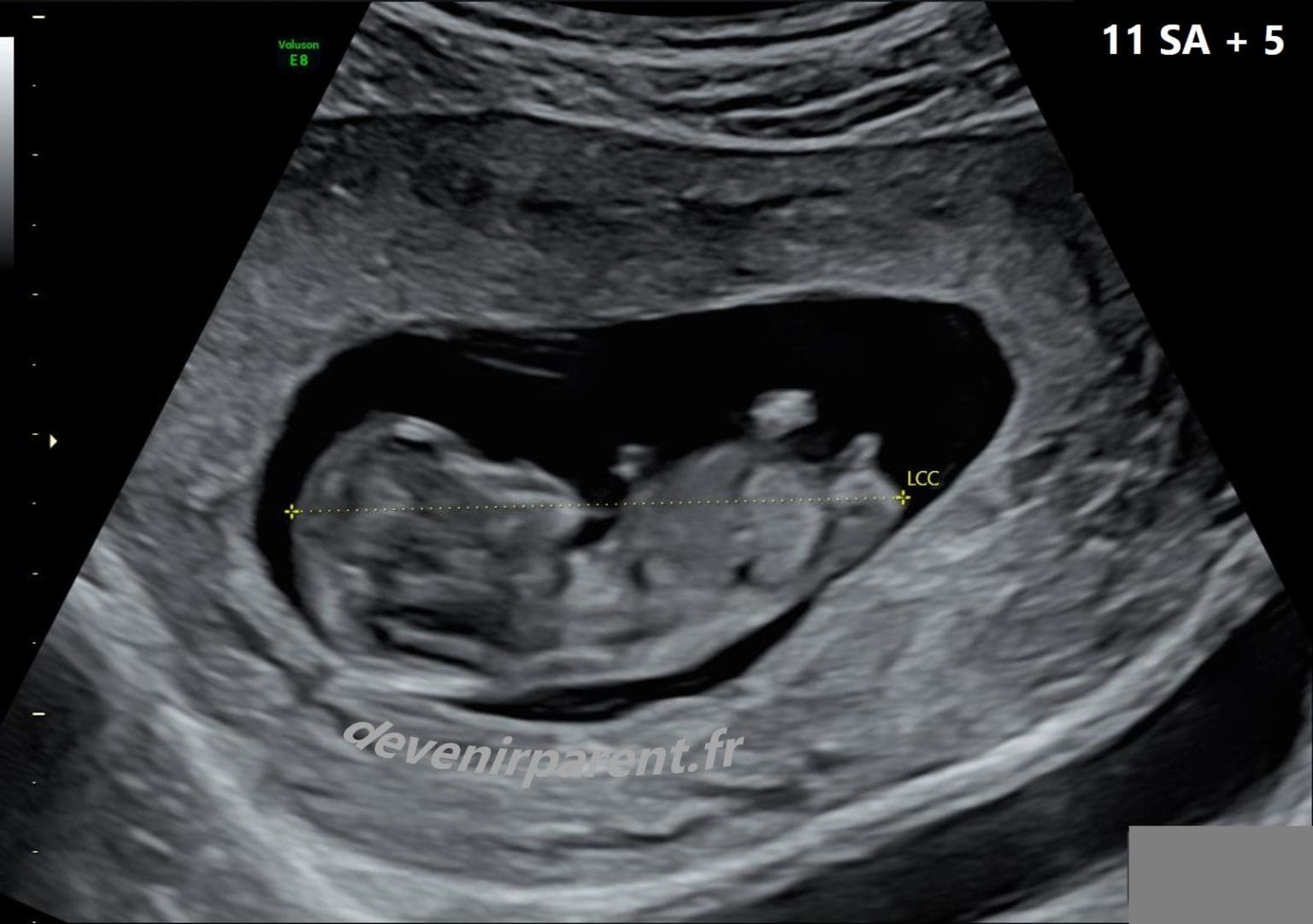 Echographie de datation et écho T1 : késako