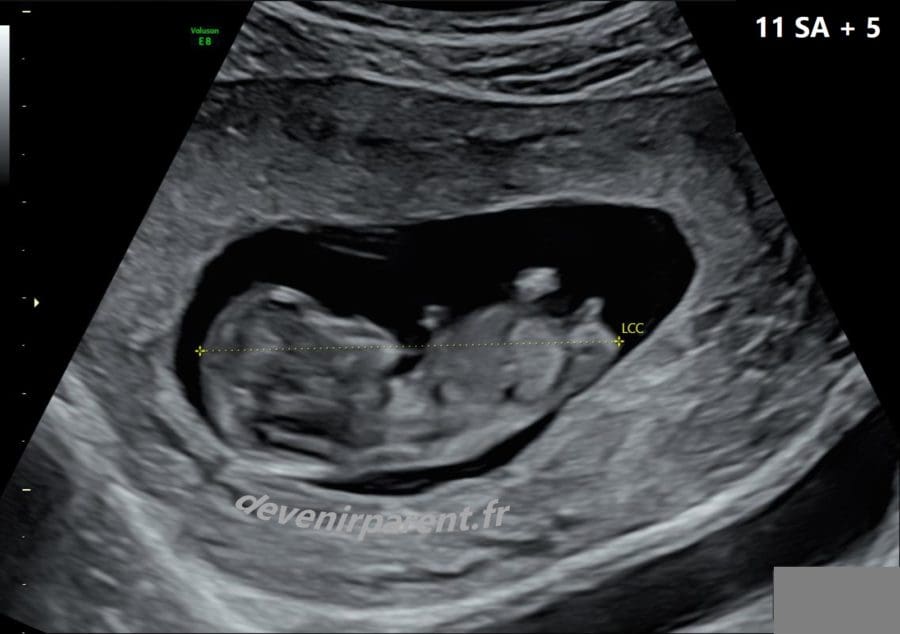 Echographie de datation et écho T1 : késako